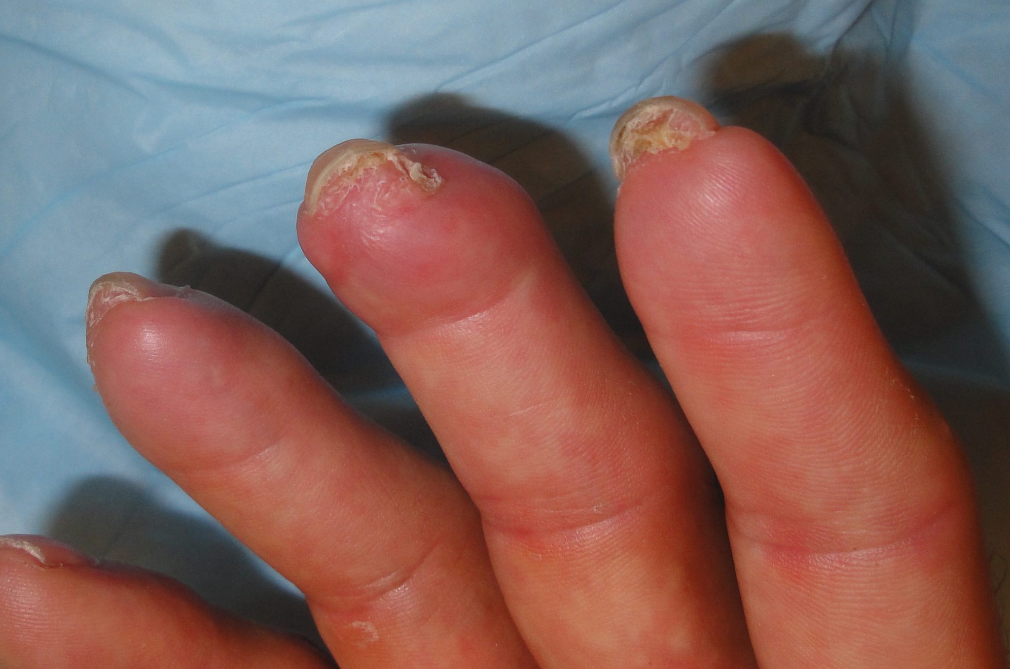 Multiple Fingertip Amputations - Best Wound Practice