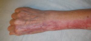 Dorsal Hand and Wrist Wounds with Exposed Tendons - Best Wound Practice