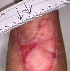 Pyoderma Gangrenosum - Best Wound Practice
