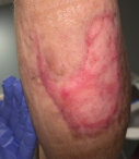 Pyoderma Gangrenosum - Best Wound Practice