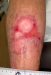 Pyoderma Gangrenosum - Best Wound Practice