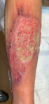 Pyoderma Gangrenosum - Best Wound Practice