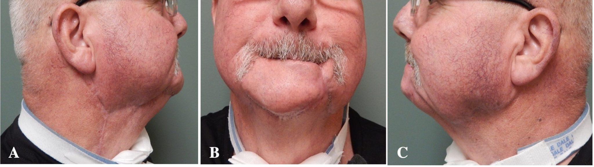 Large Lower Face Defect from Gunshot Wound. - Best Wound Practice