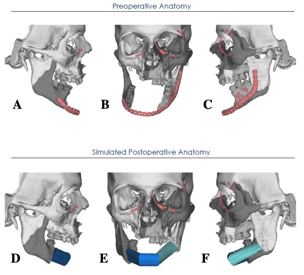 Large Lower Face Defect from Gunshot Wound. - Best Wound Practice