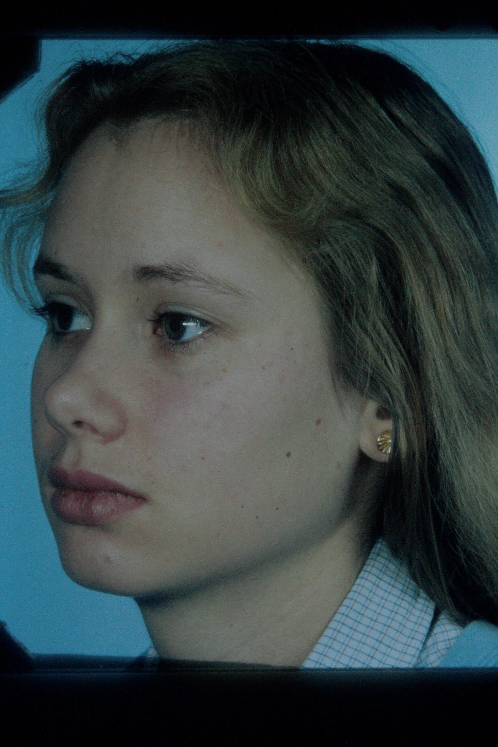 Facial Burn, Superficial (1st degree) Healed with Topical Treatment ...