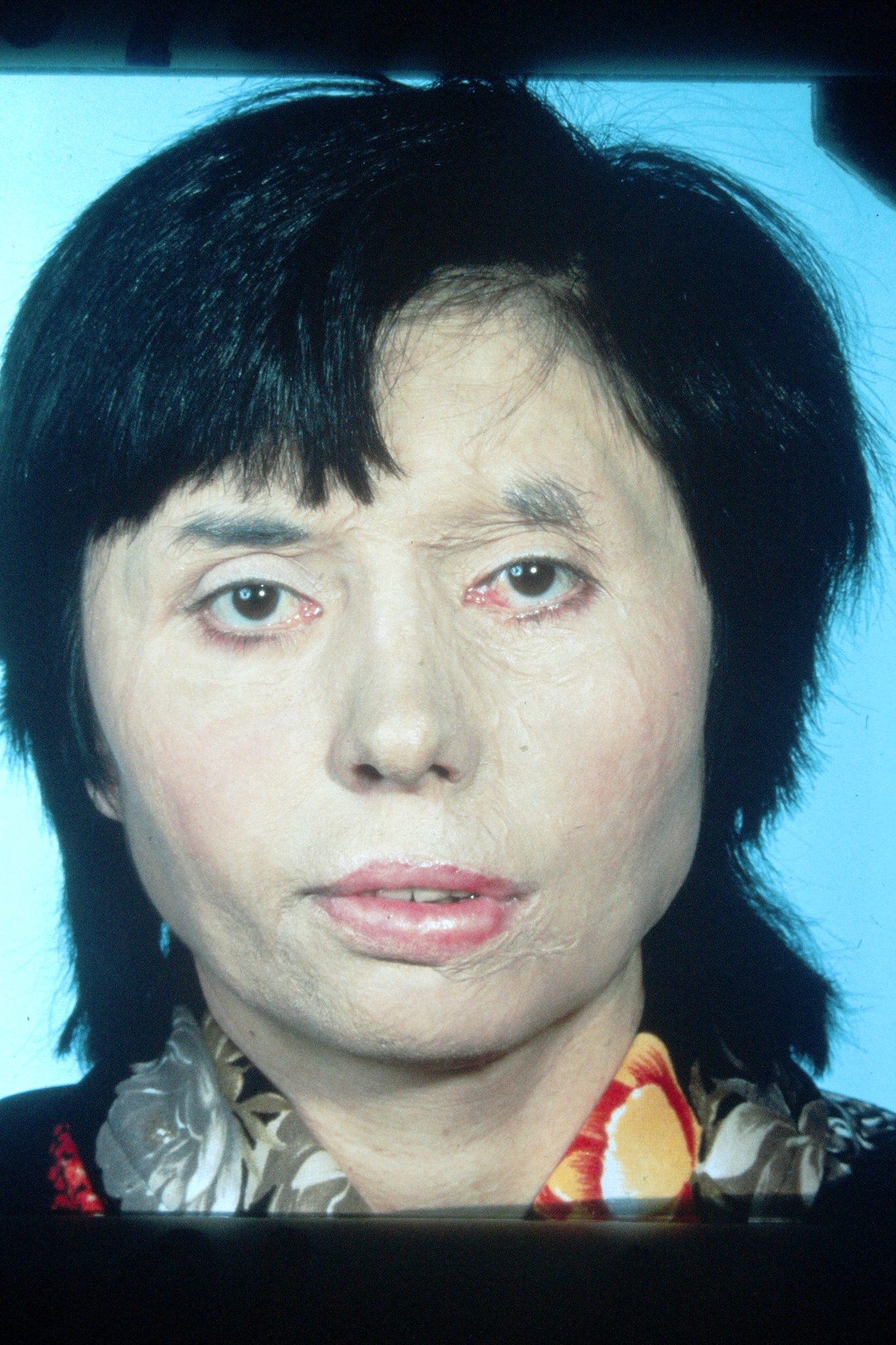 Facial Burn, Deep, Full Thickness (3rd degree) Treated with Split ...