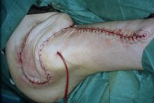 Trochanteric Pressure Sore in Patient with advanced MS closed with ...