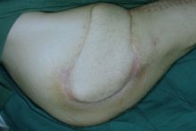 Trochanteric Pressure Sore in Patient with advanced MS closed with ...