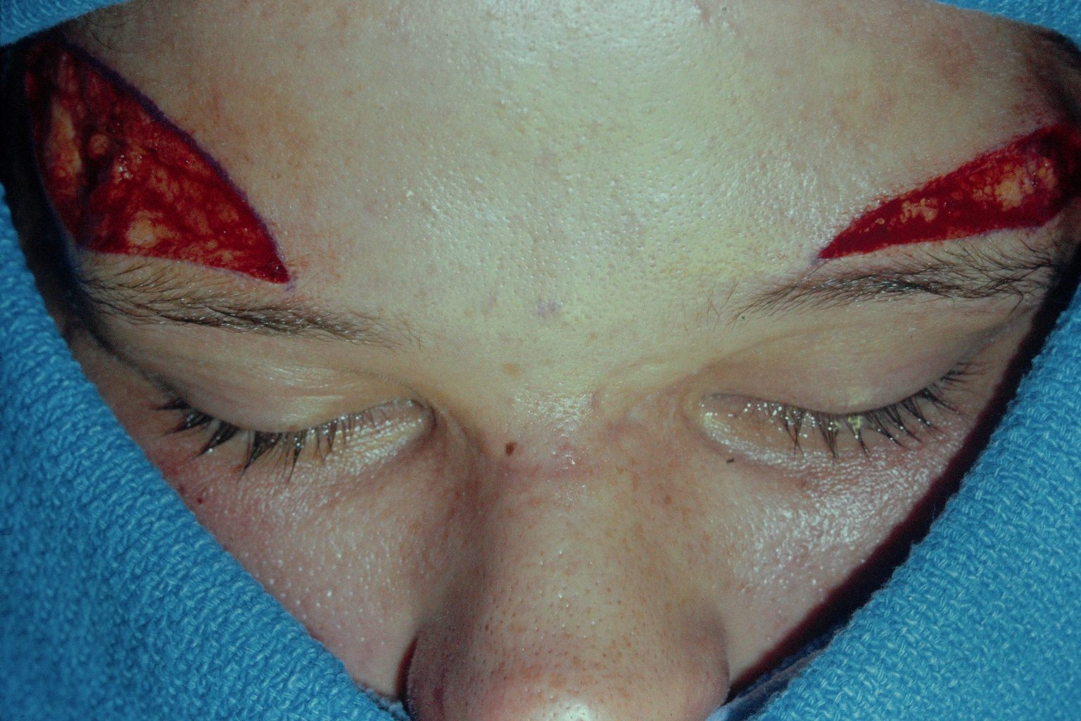 Scalp Avulsion with Successful Replantation - Best Wound Practice