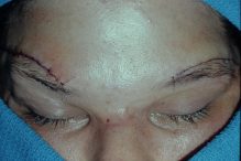 Scalp Avulsion with Successful Replantation - Best Wound Practice