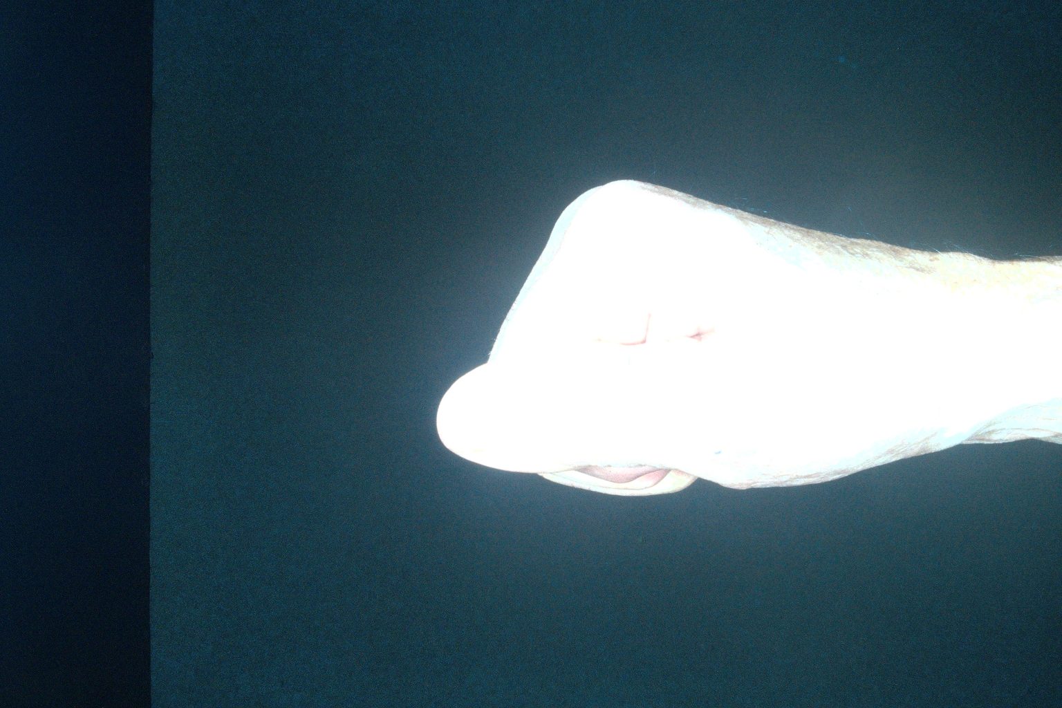 Hand Burn, Deep (3rd degree) treated with Split Thickness Skin Graft ...