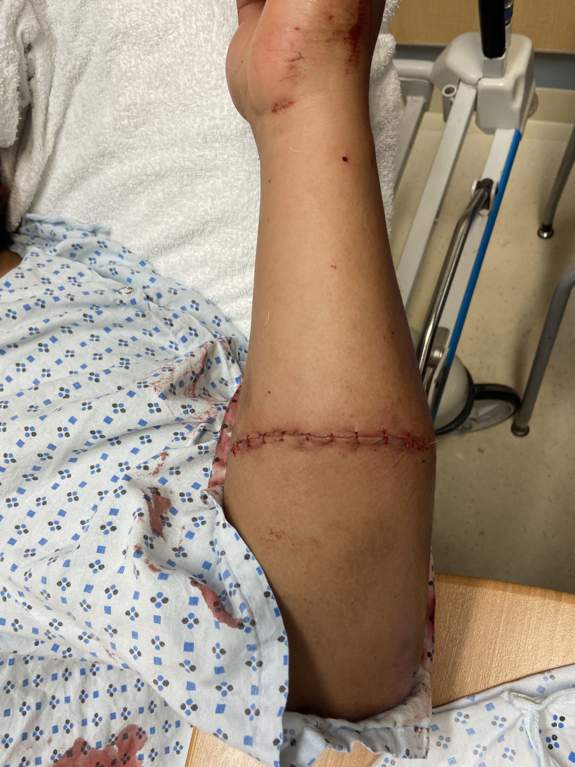 Stab Wound to Left Upper Extremity - Best Wound Practice