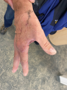 Dog Bite to right hand - Best Wound Practice