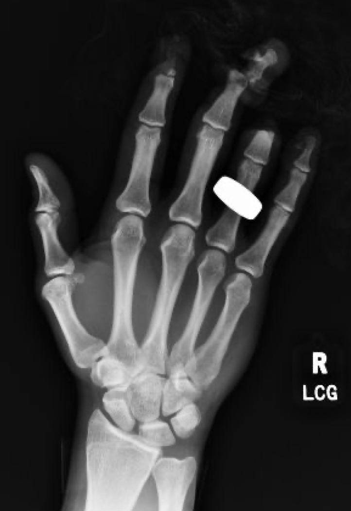 Multi-Digit Circular Saw Injury to Right Hand - Best Wound Practice