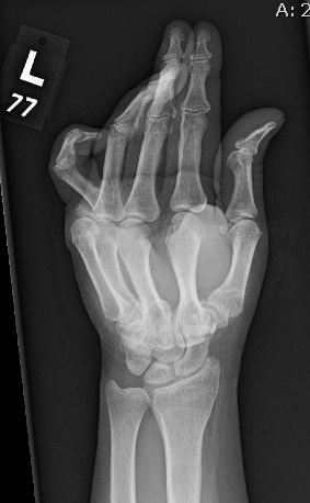 Subluxation of small finger MCP joint with open wound - Best Wound Practice