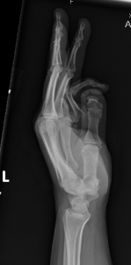 Subluxation of small finger MCP joint with open wound - Best Wound Practice