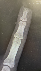 Finger tip amputation with no exposed bone - Best Wound Practice