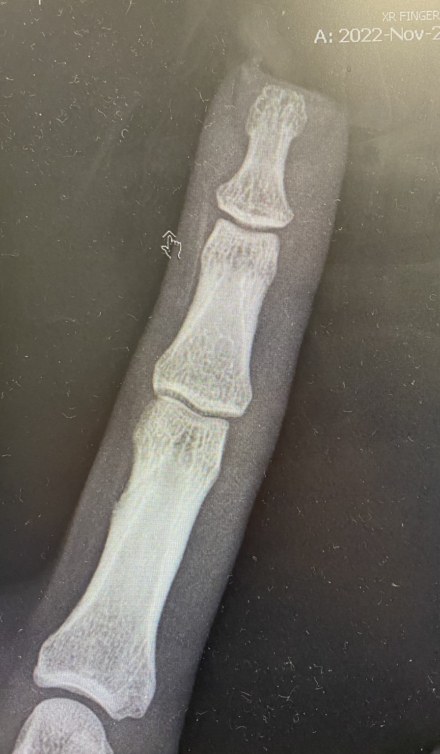 Finger tip amputation with no exposed bone - Best Wound Practice