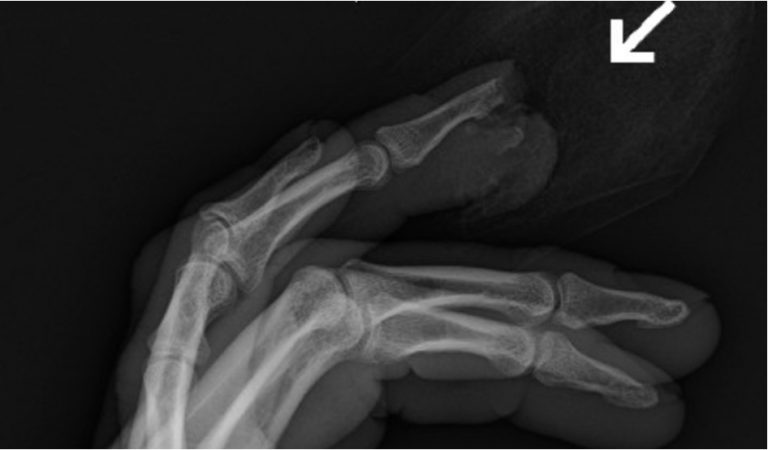 Ischemic fingertip partial avulsion injury - Best Wound Practice