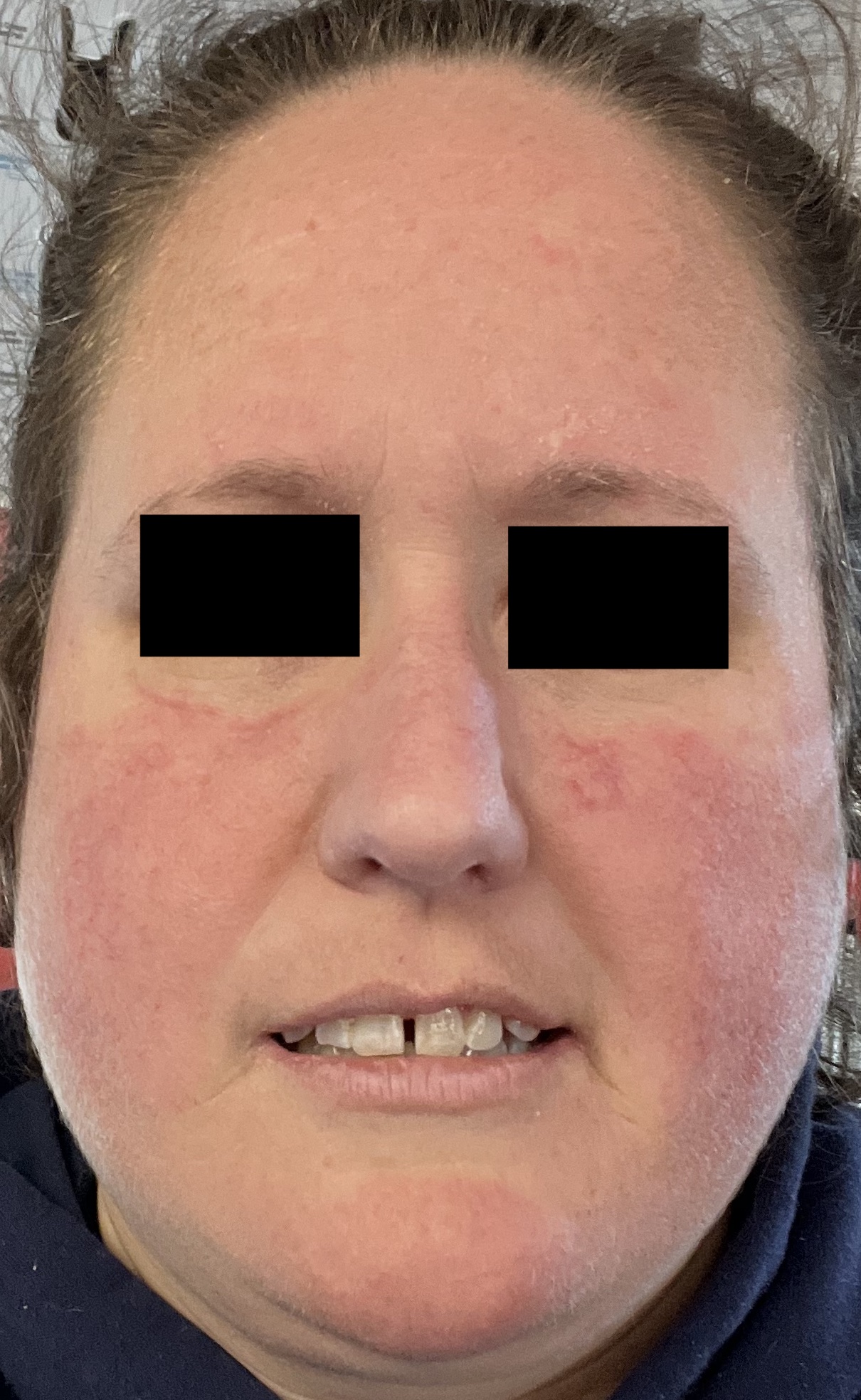 Animal Bite to the Face - Best Wound Practice