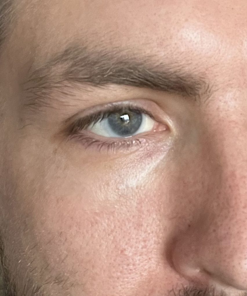 Dog bite to lower eyelid - Best Wound Practice