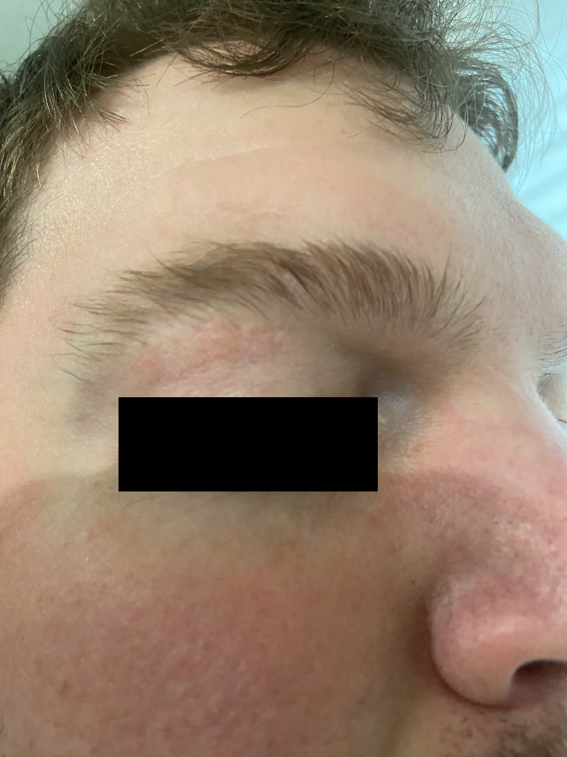 Dog Bite to Face/Nose - Best Wound Practice