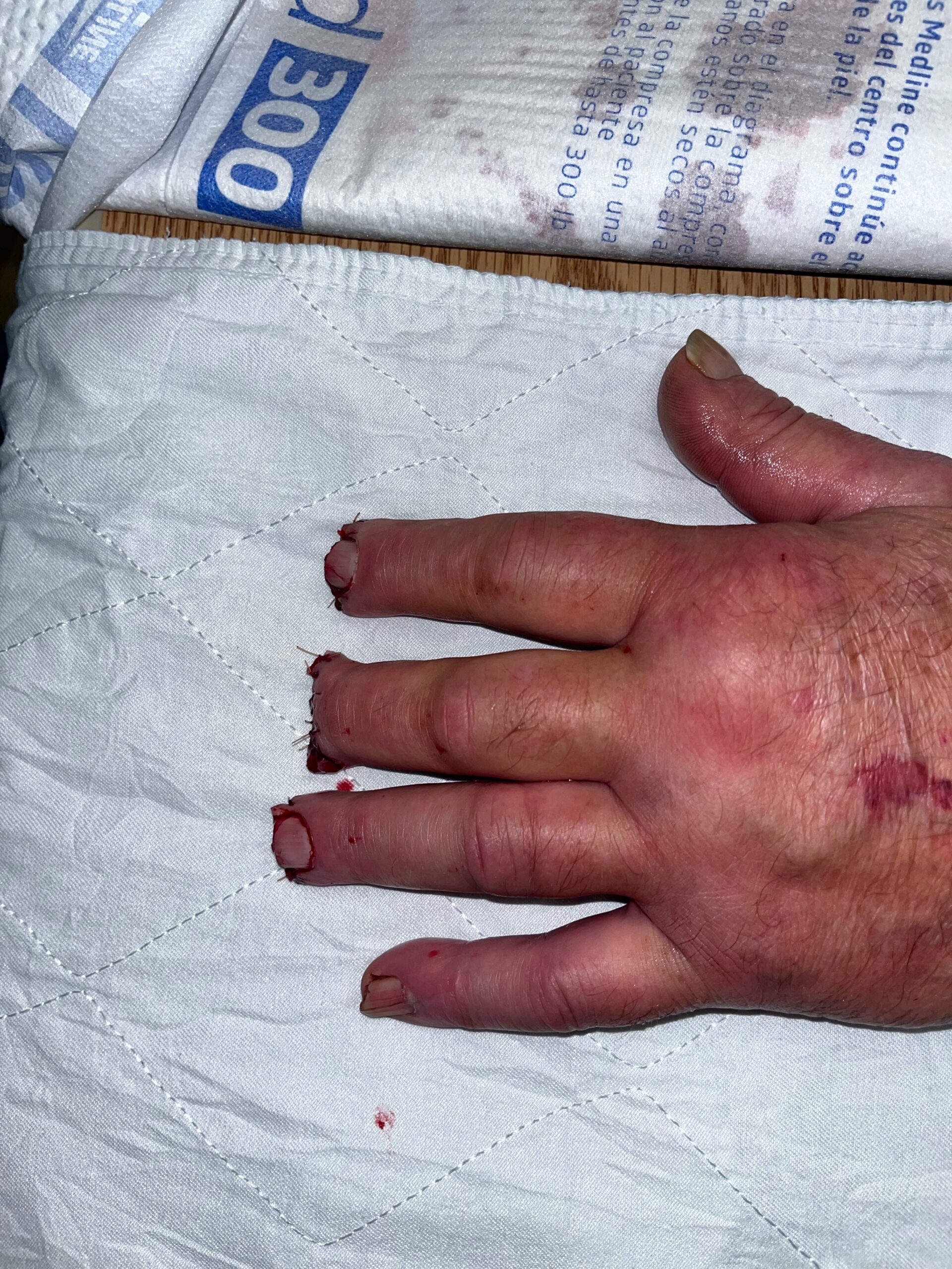 Traumatic Amputation of the Left Index, Middle, and Ring Fingers ...