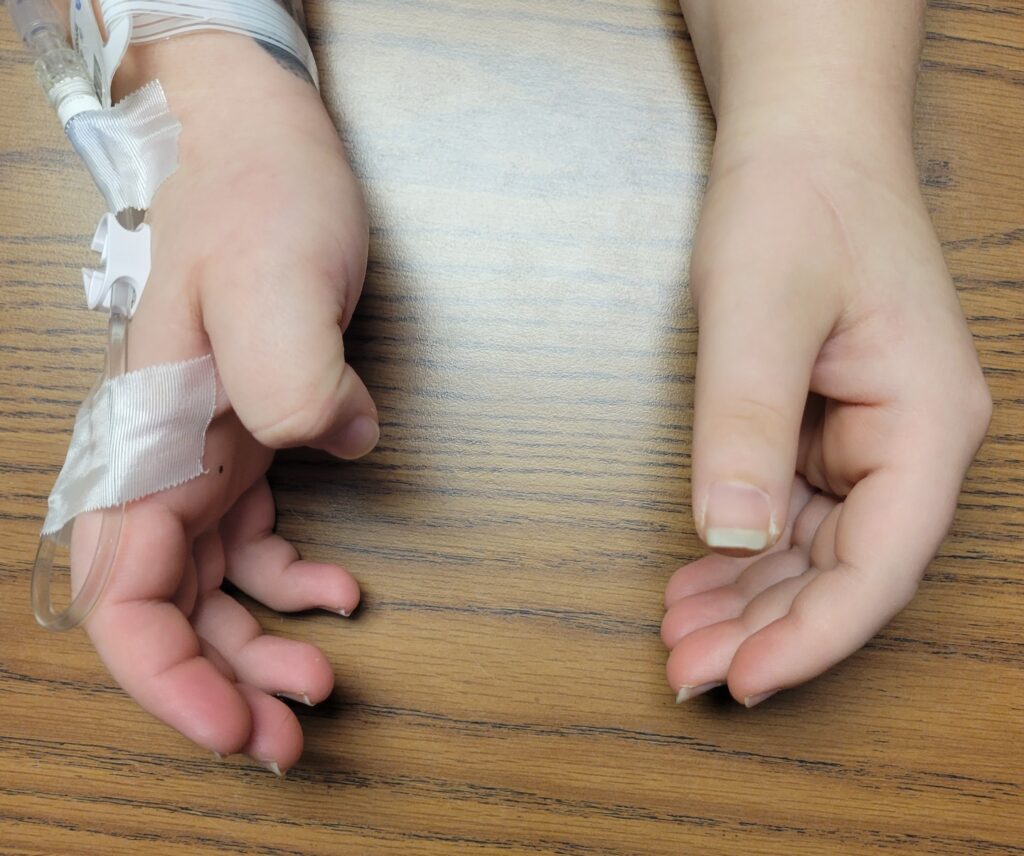 Left Volar Thumb Wound with Transection of Flexor Pollicis Longus ...