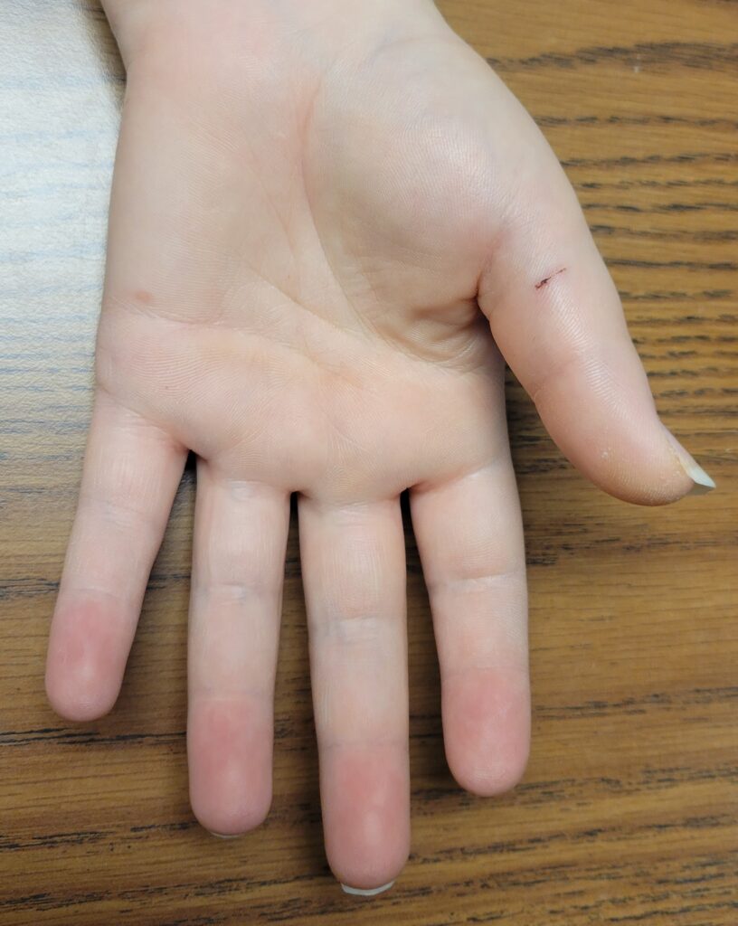 Left Volar Thumb Wound with Transection of Flexor Pollicis Longus ...