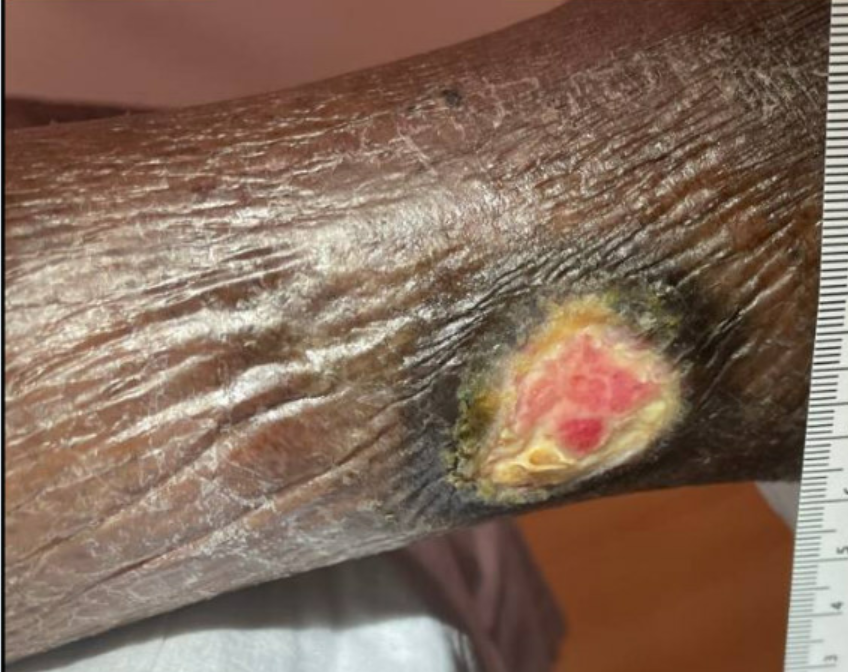 Arterial ulcers of the lower extremity - Best Wound Practice