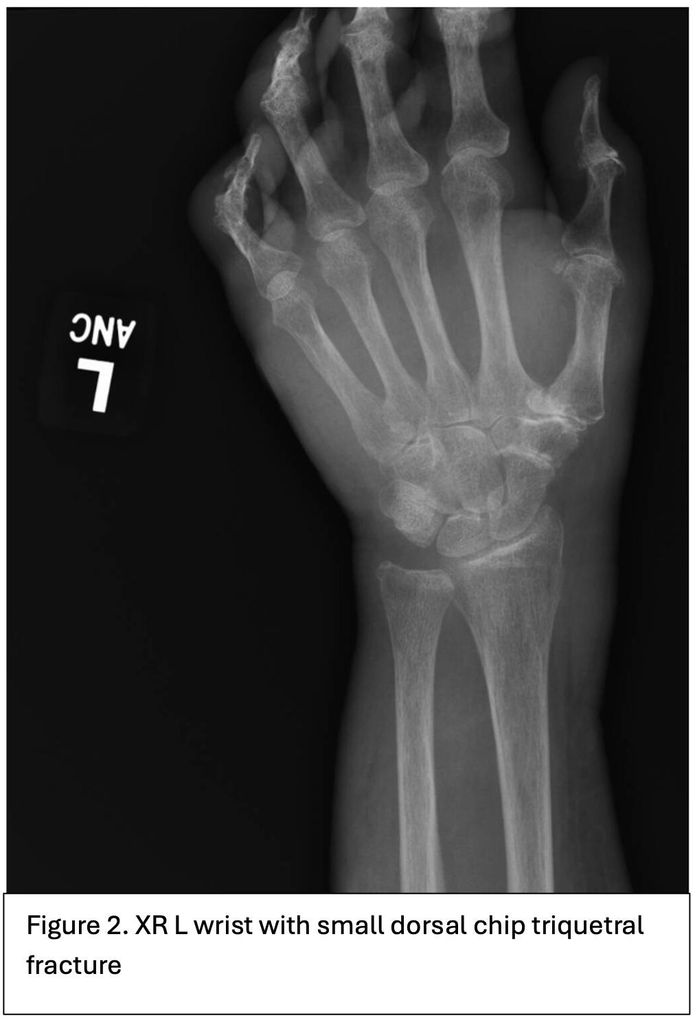 Dorsal Hand Hematoma - Best Wound Practice