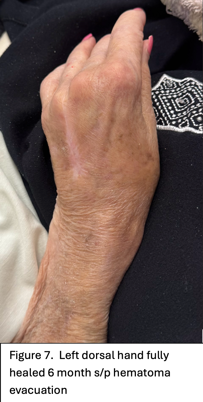 Dorsal Hand Hematoma - Best Wound Practice